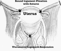 The Best Hysteropexy Procedure - Cosmetic Vaginal Surgery Atlanta ...