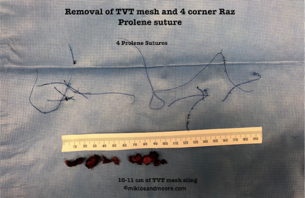 TVT Advantage Sling Removal - Failed Mesh Removal at UCLA - Cosmetic ...